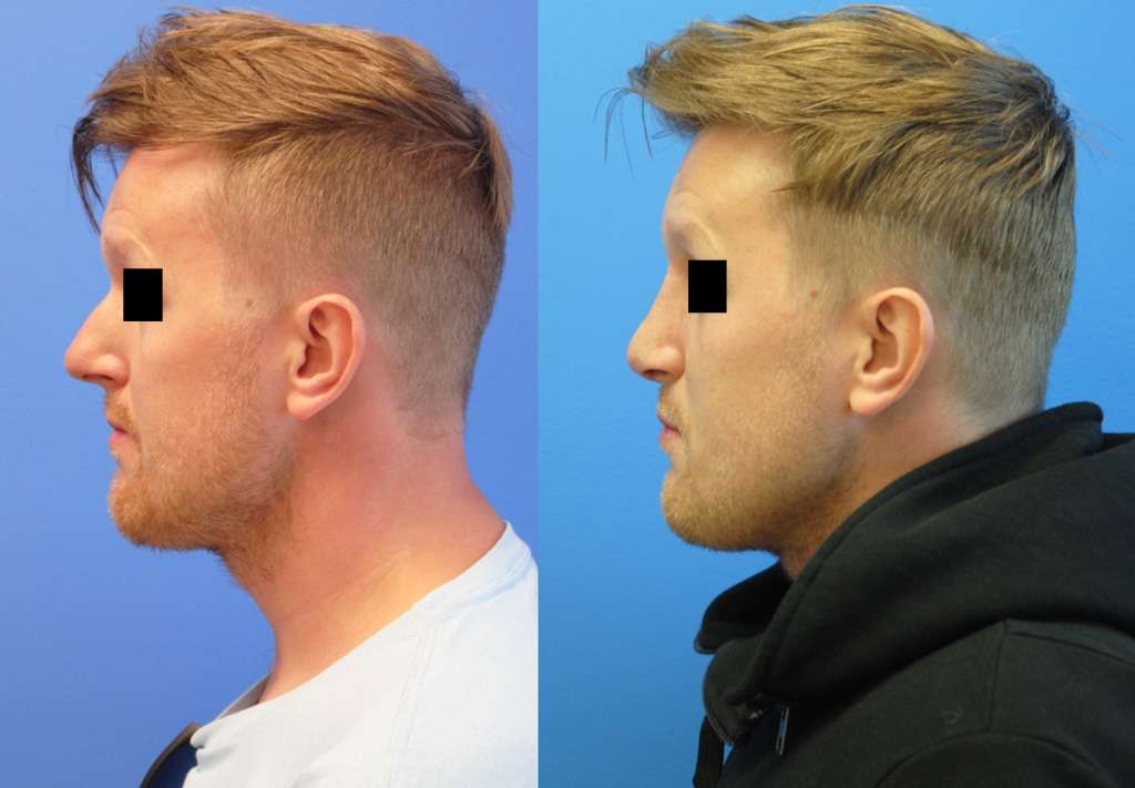 Why some people have longish midfaces (0.9 to 0.98) but dont look like ...